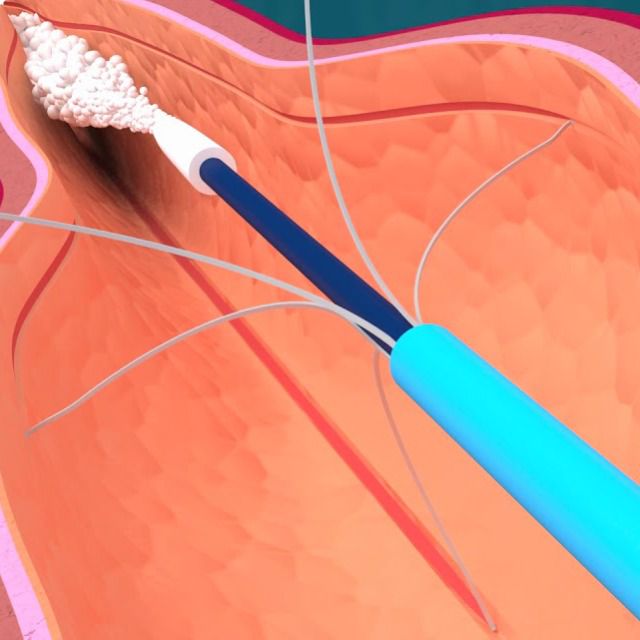 Механо-химическая абляция Flebogrif - Флебология (лечение варикоза ...